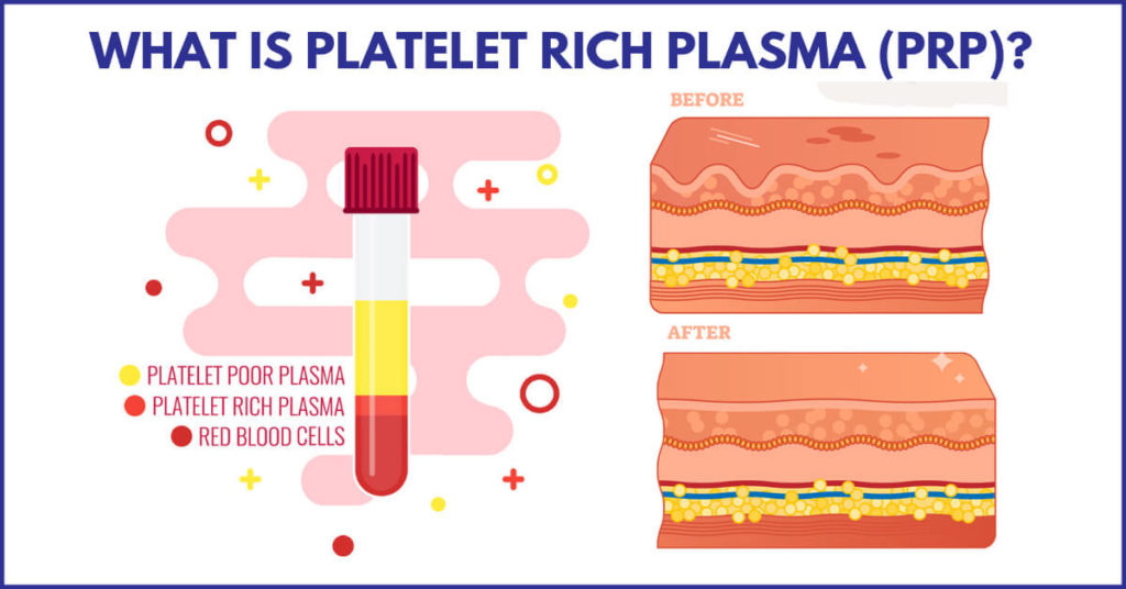 PRP Facial & PRP Facelift - Hinsdale Vein & Laser