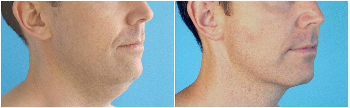 Monthly Specials - Hinsdale Vein and Laser