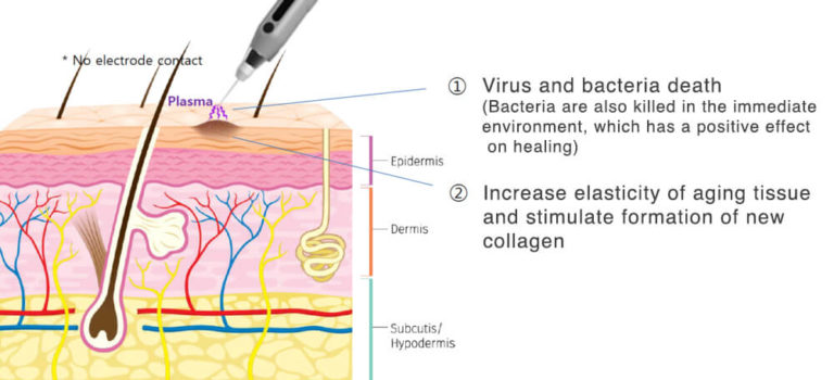 Plaxel Pen - True Plasma Skin Tightening - Hinsdale Vein & Laser